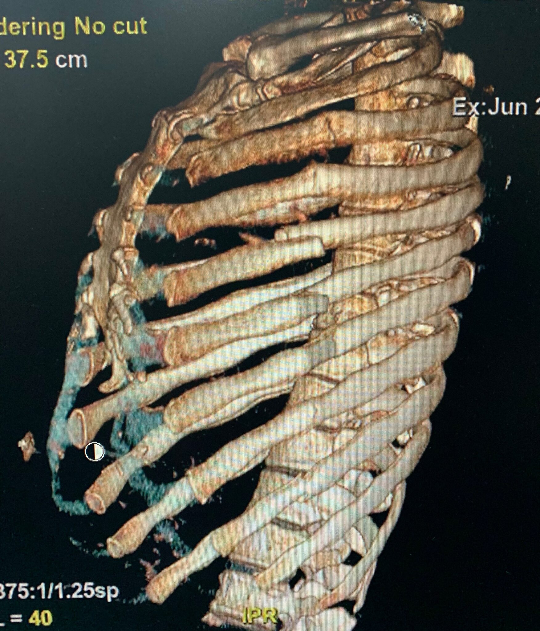 Clínica de Pared Torácica / Fracturas Costales - Cirujano de Tórax ...